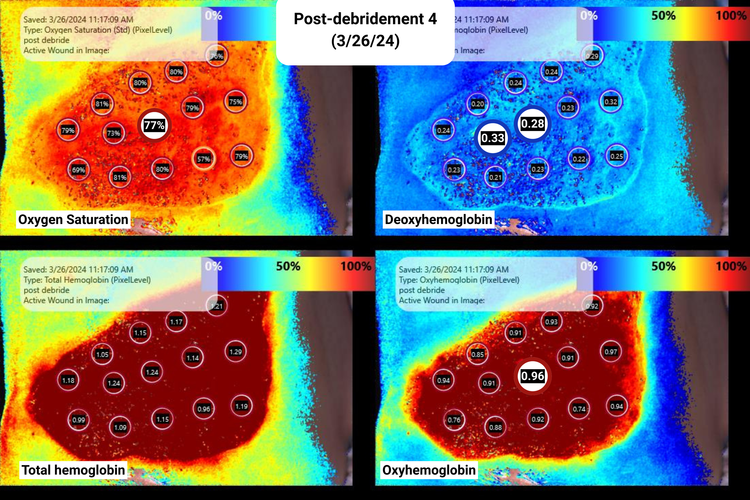 Wound Debridement and Skin Graft: A Case Study on Optimized Healing ...