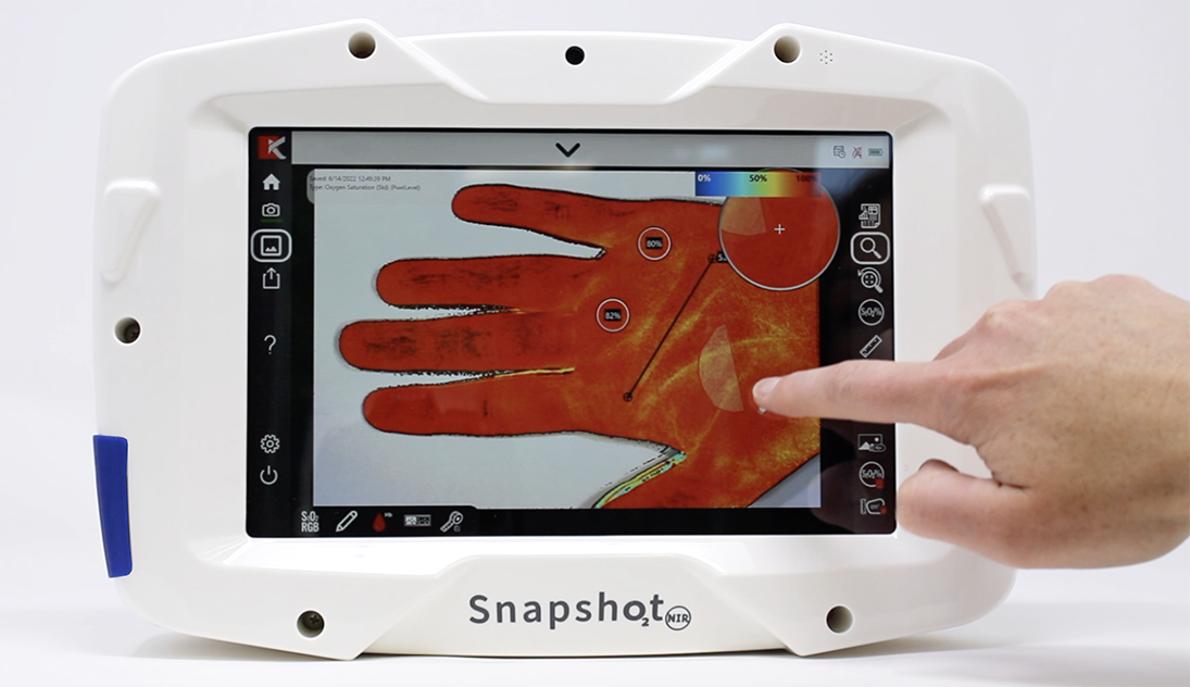 Effective Wound Care Solutions with SnapshotNIR — Kent Imaging