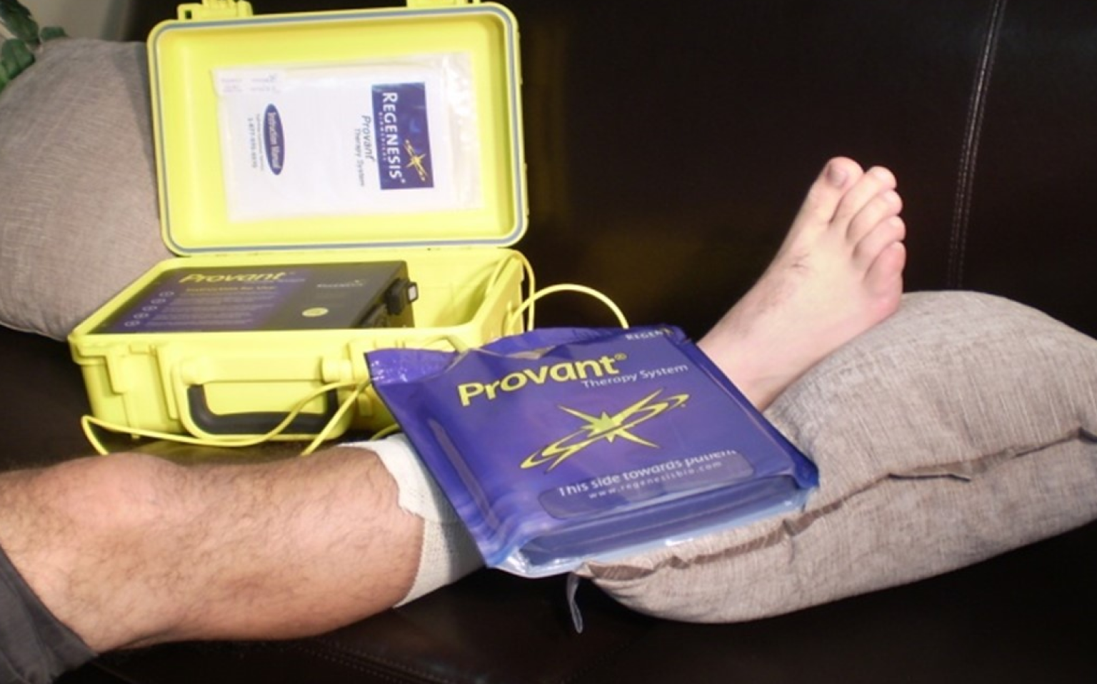 EVALUATION OF TISSUE OXYGENATION SATURATION USING NIRS FOLLOWING PRFE ...