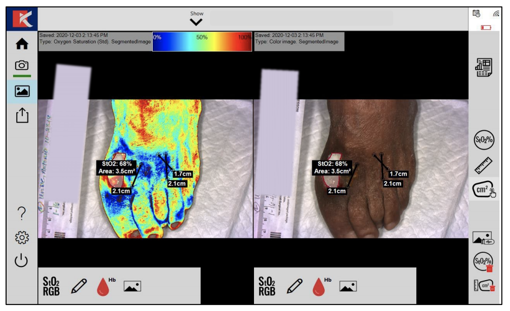 Measurement and Documentation in Wound Care — Kent Imaging