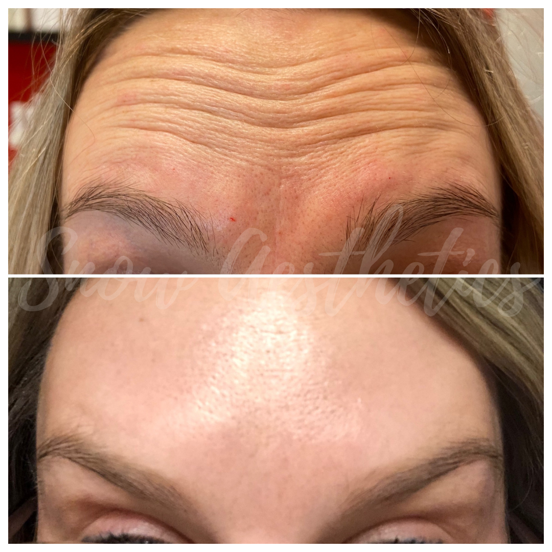 Botox & Jeuveau — Snow Aesthetics
