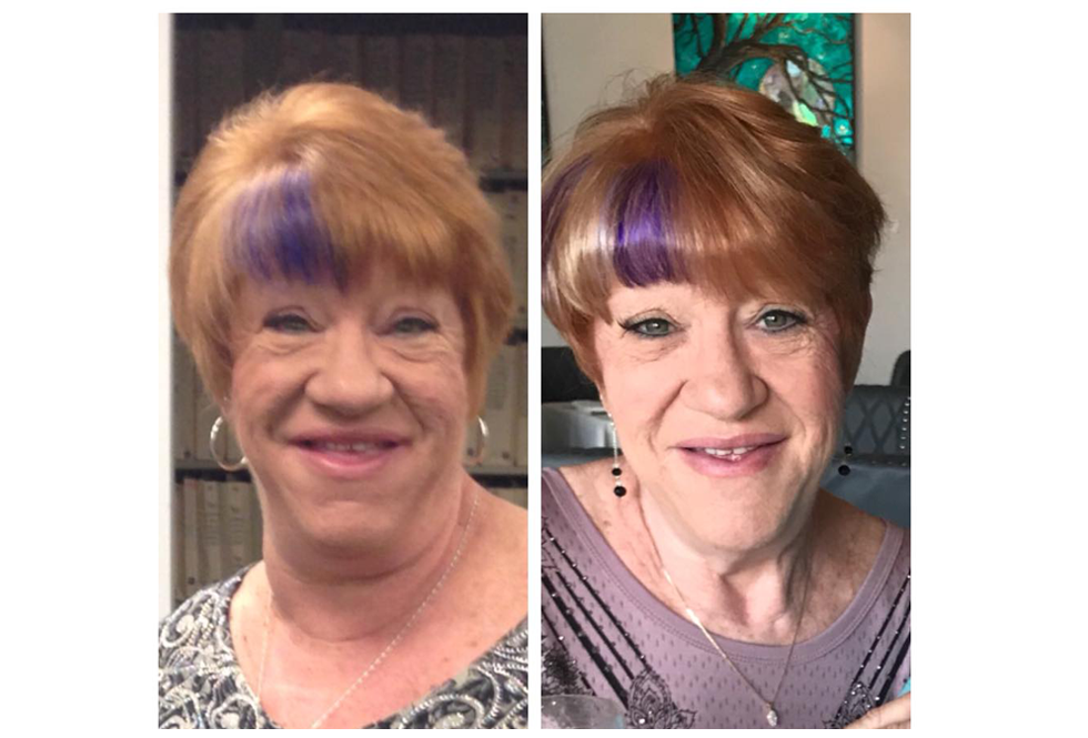 Faces of Hope — Acromegaly Community
