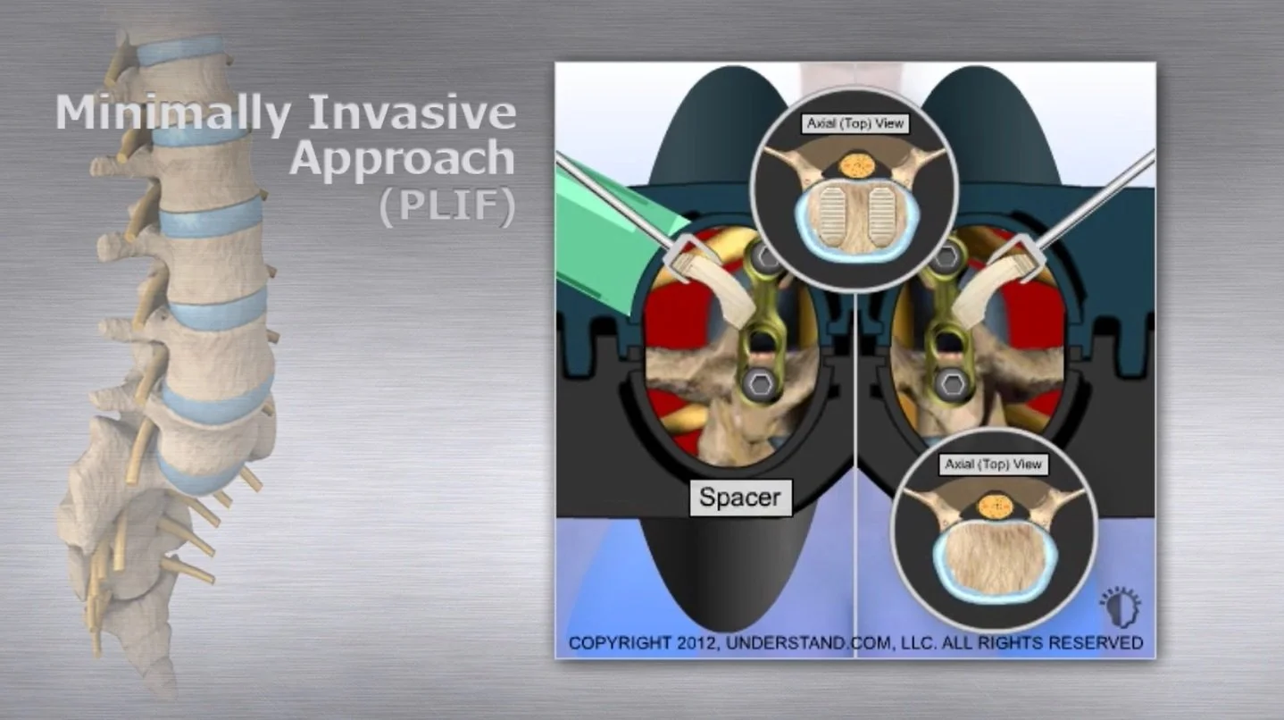 Informational Videos — reVive Spine Center