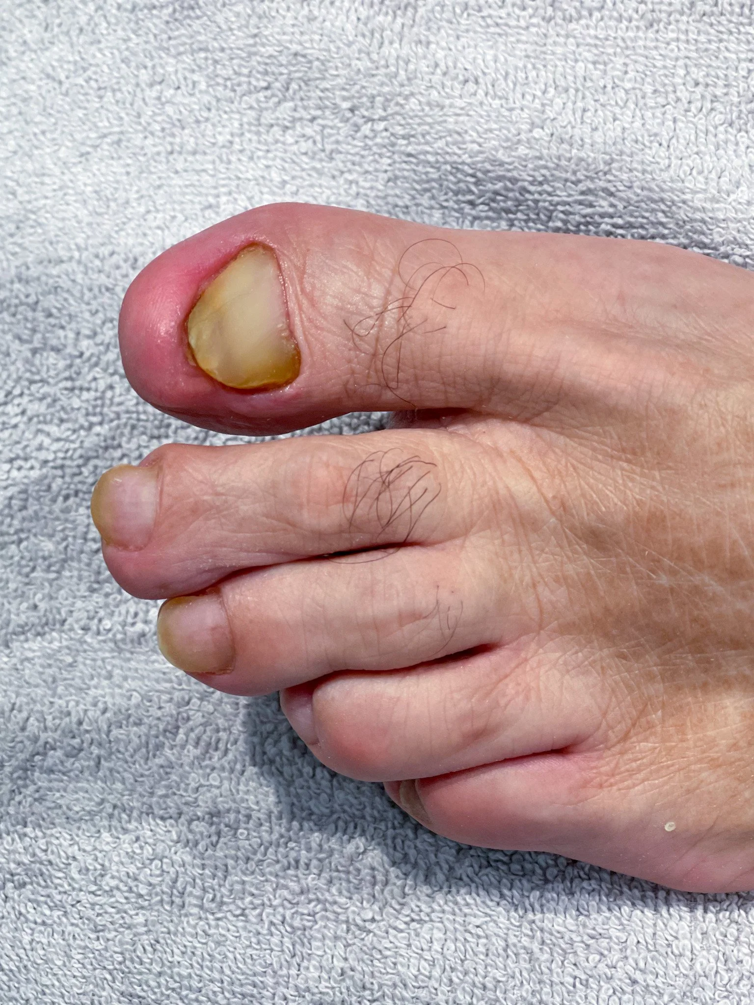 Get Advanced Footcare Treatment in Vancouver | Say Goodbye to Corns and ...