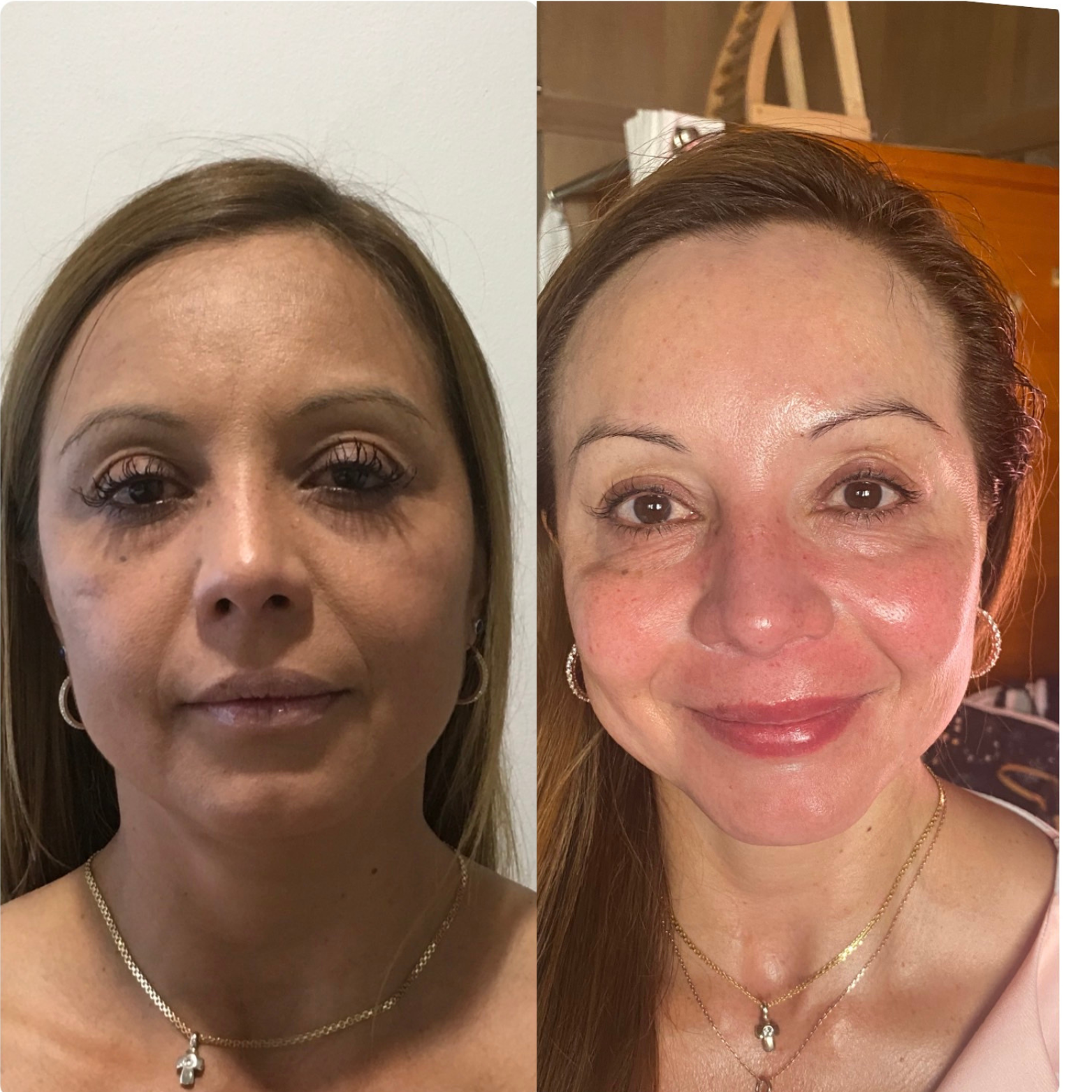 Fascia Sculpt in La Jolla | Tamara Renee
