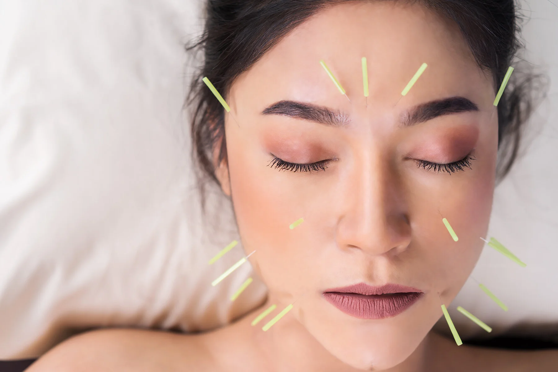 Cosmetic Acupuncture In Herndon Virginia Striving For Health Cosmetic Acupuncture In Herndon Virginia Striving For Health