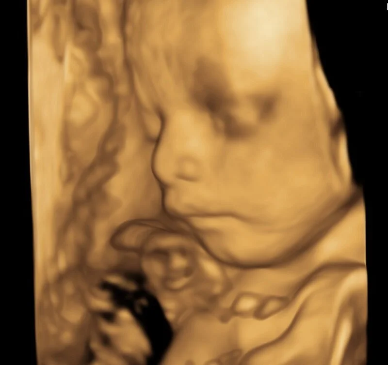 Pregnancy Scans — Galway Ultrasound Specialists