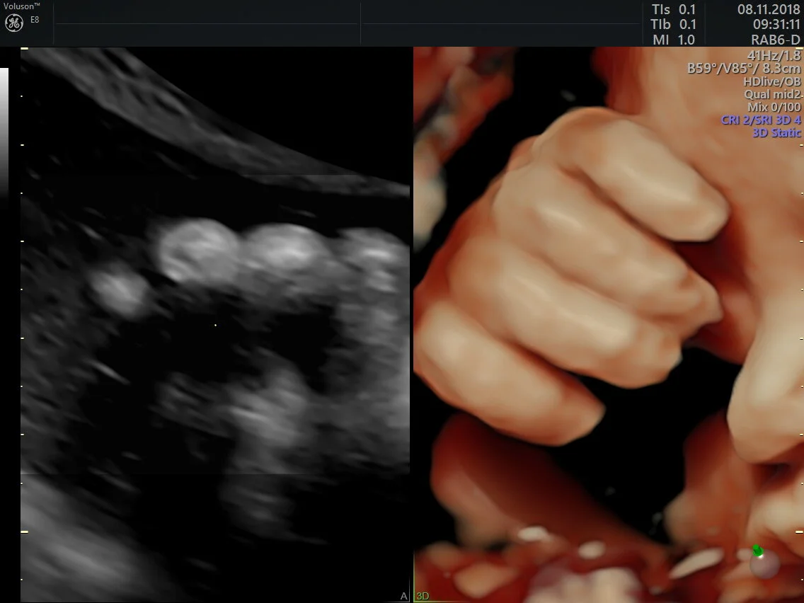 Pregnancy Scans — Galway Ultrasound Specialists
