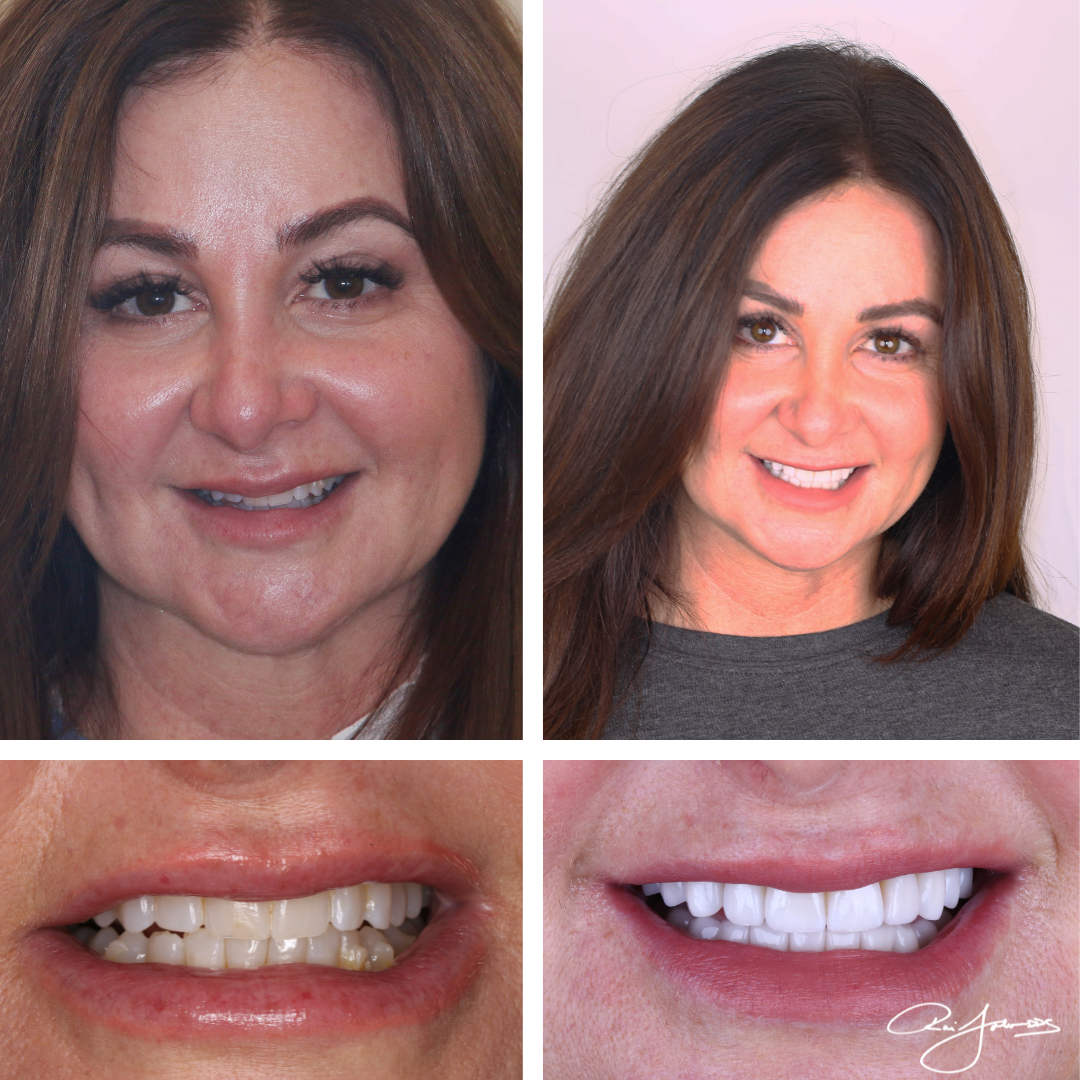 Smile Gallery — Rami D. Salha, DDS - Atrium Dental Studio