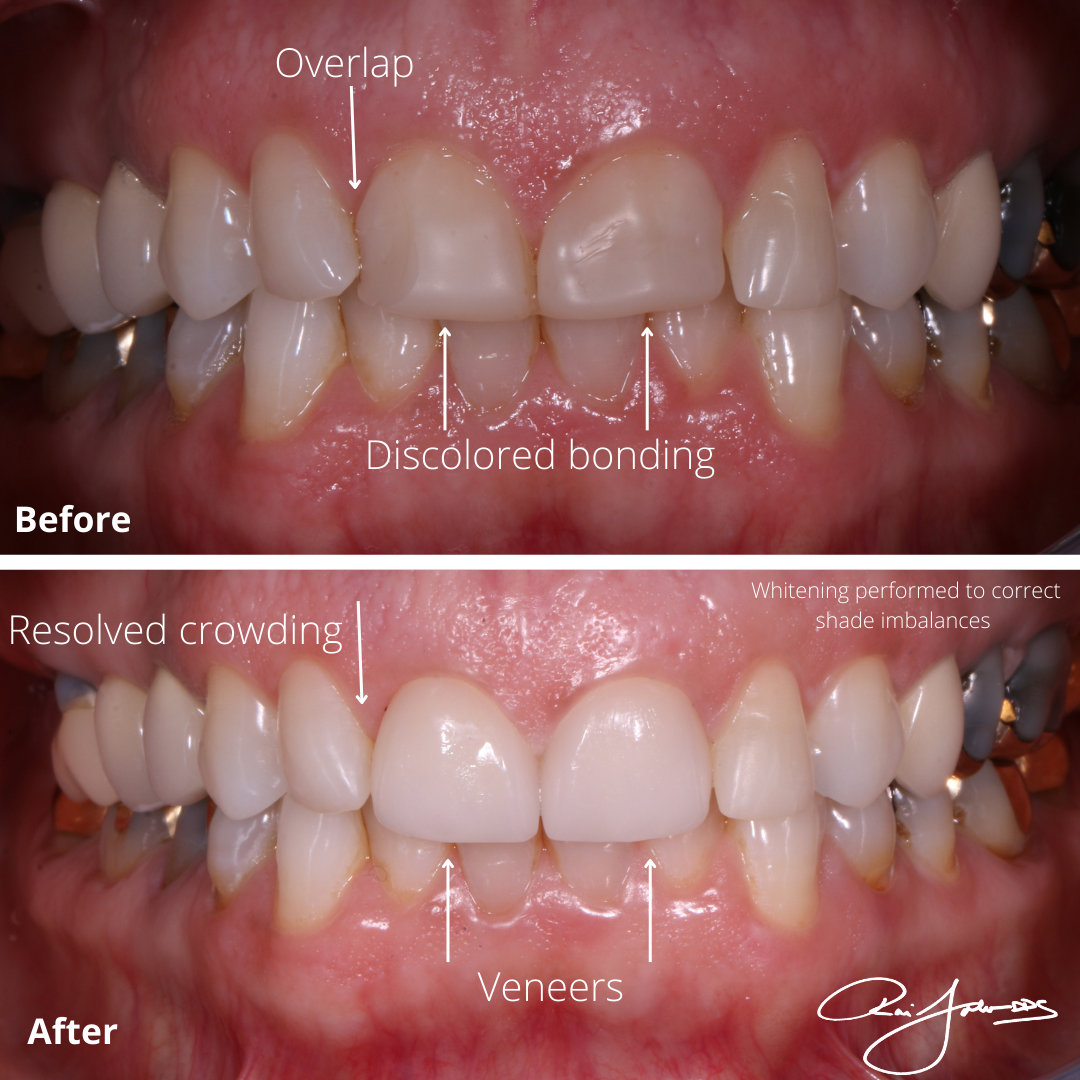 Smile Gallery — Rami D. Salha, DDS - Atrium Dental Studio