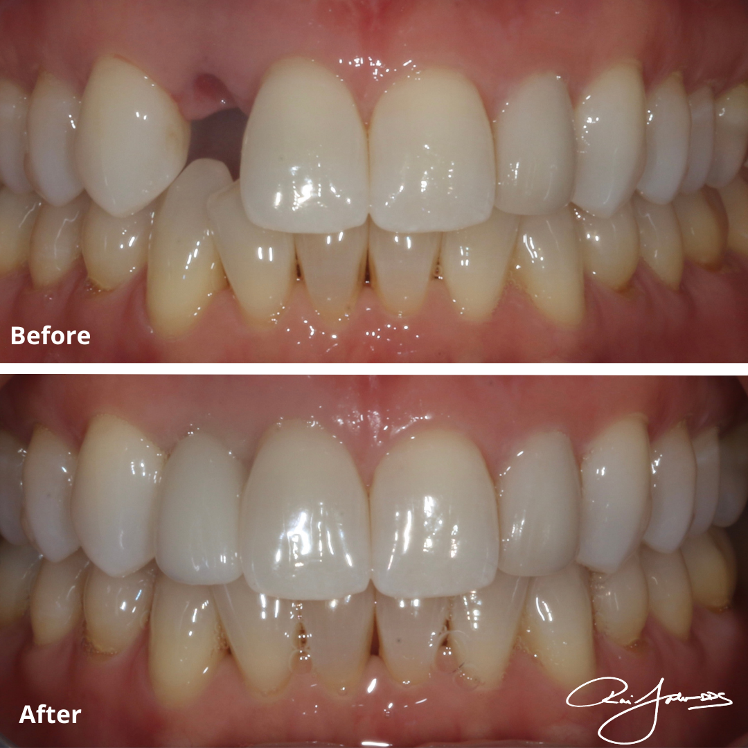 Smile Gallery — Rami D. Salha, DDS - Atrium Dental Studio