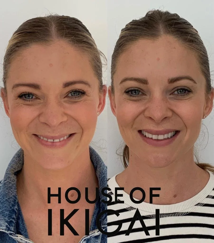 Botox Explained — House of Ikigai