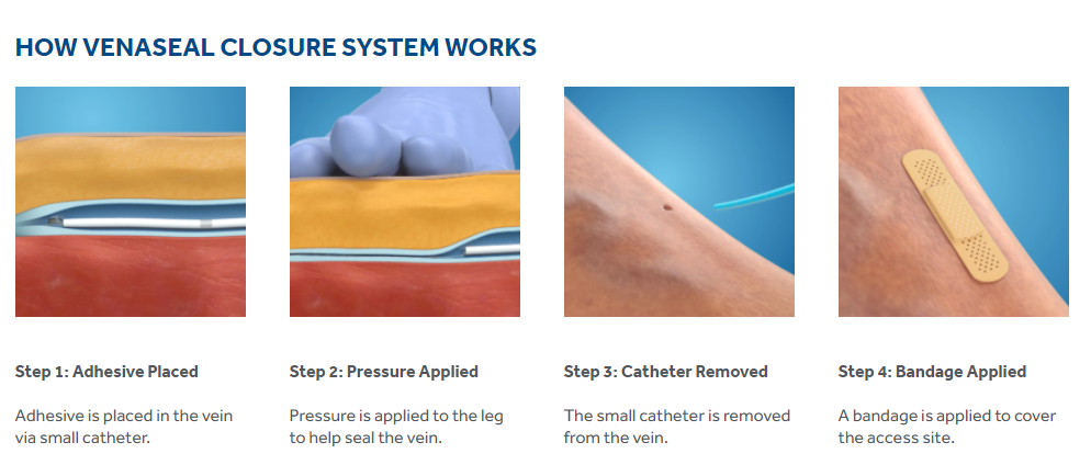 Vein Institute - Venaseal™ Varicose Vein Treatment in CT