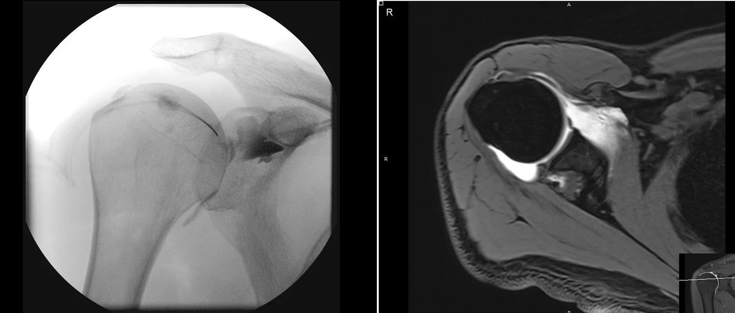 Fluoroscopy Guided Arthrograms and Pain Medication Injections serving ...