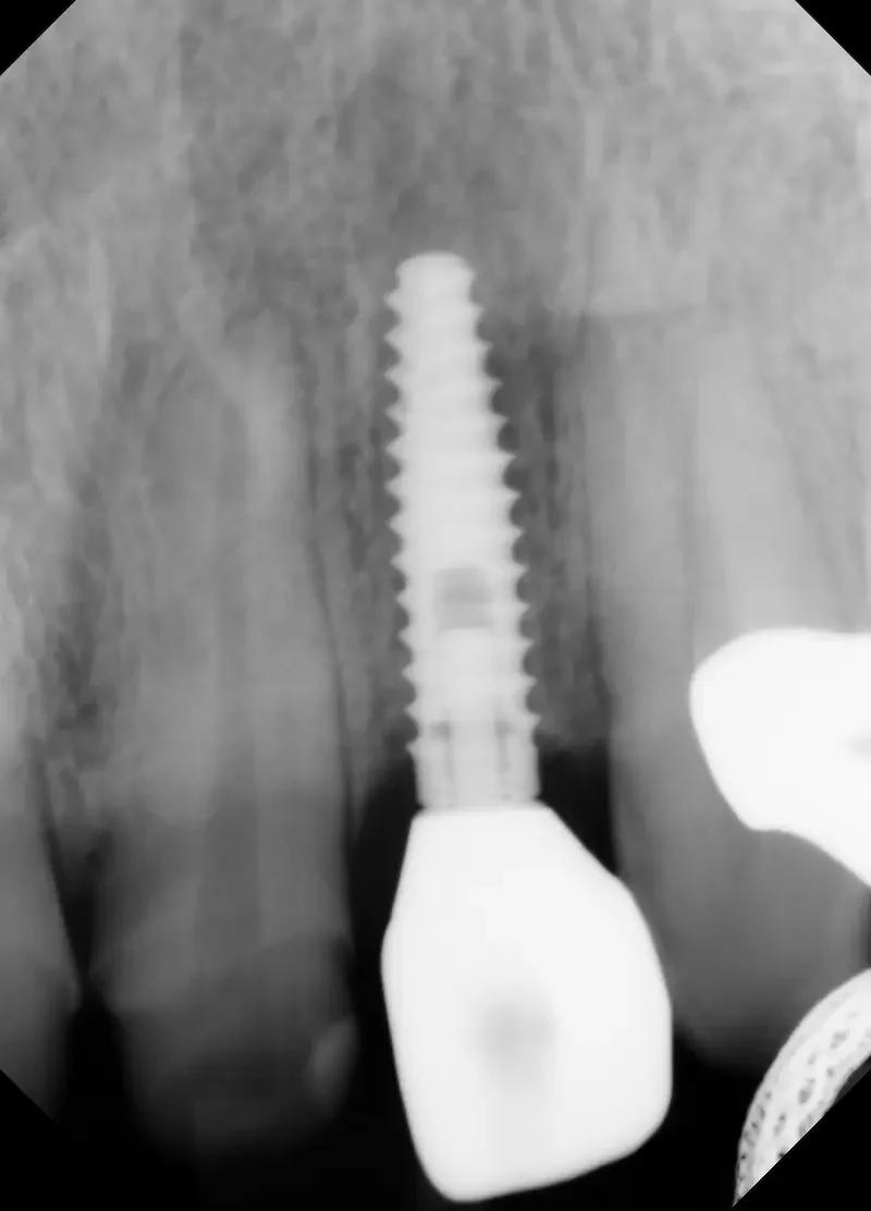 The Truth About Same Day Extractions And Implants In St Charles The Truth About Same Day Extractions And Implants In St Charles