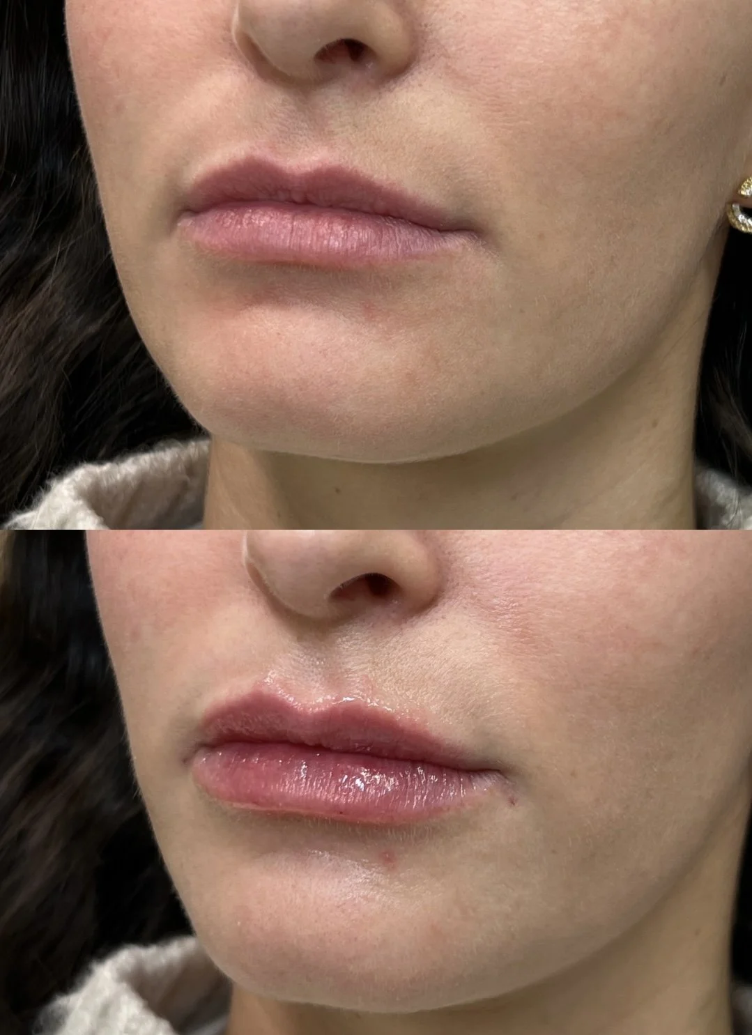 Lip Filler For A Natural Look | Defy Aesthetic®