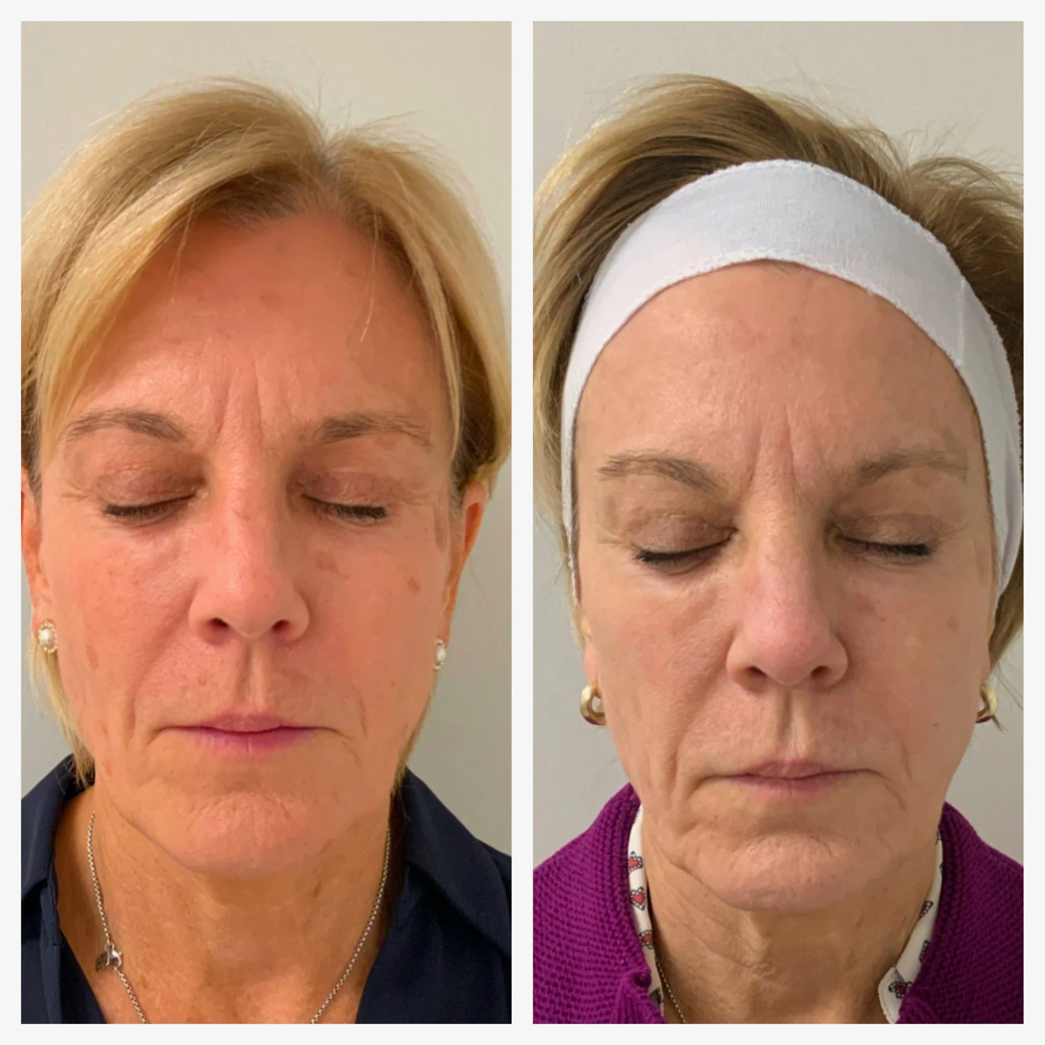 Sunspots On Skin Treatment | Defy Aesthetic®