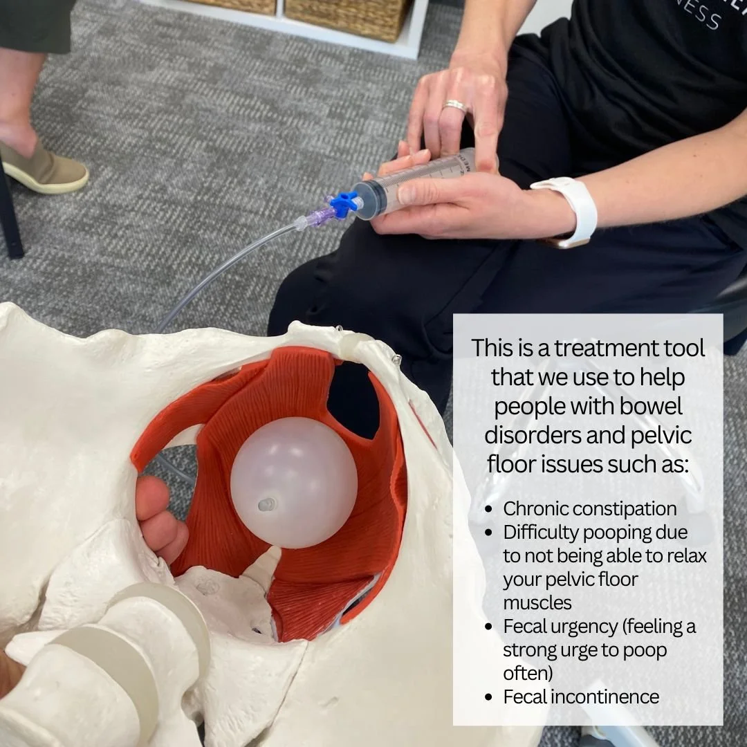 Intrarectal Balloon Training: How it can help you with your bowel ...