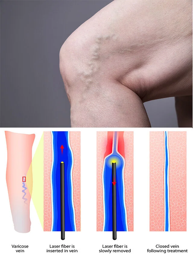 Endovenous Laser Treatment — The Vein Treatment Centre