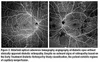 OCT and OCTA Imaging in Diabetes and Diabetic Retinopathy | Woo University
