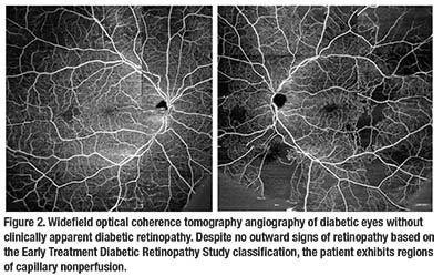 OCT and OCTA Imaging in Diabetes and Diabetic Retinopathy | Woo University