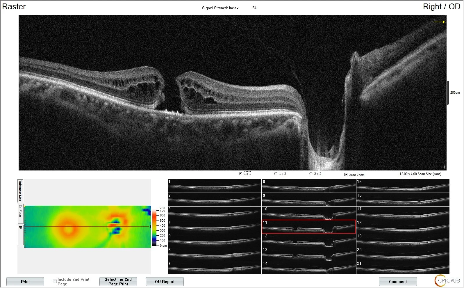 OCT in the Diagnosis of Vitreomacular Disease | Woo University
