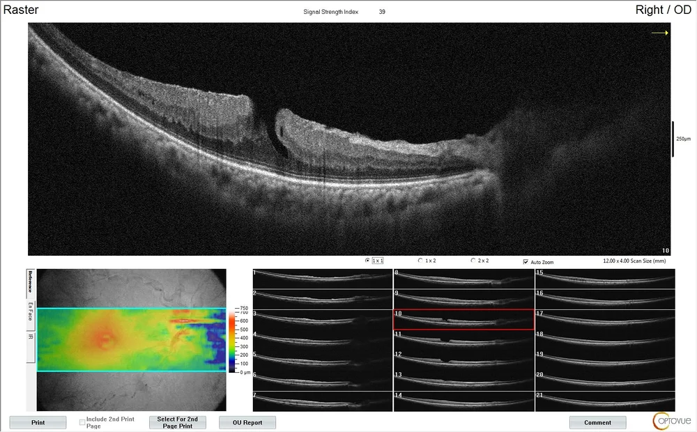 OCT in the Diagnosis of Vitreomacular Disease | Woo University
