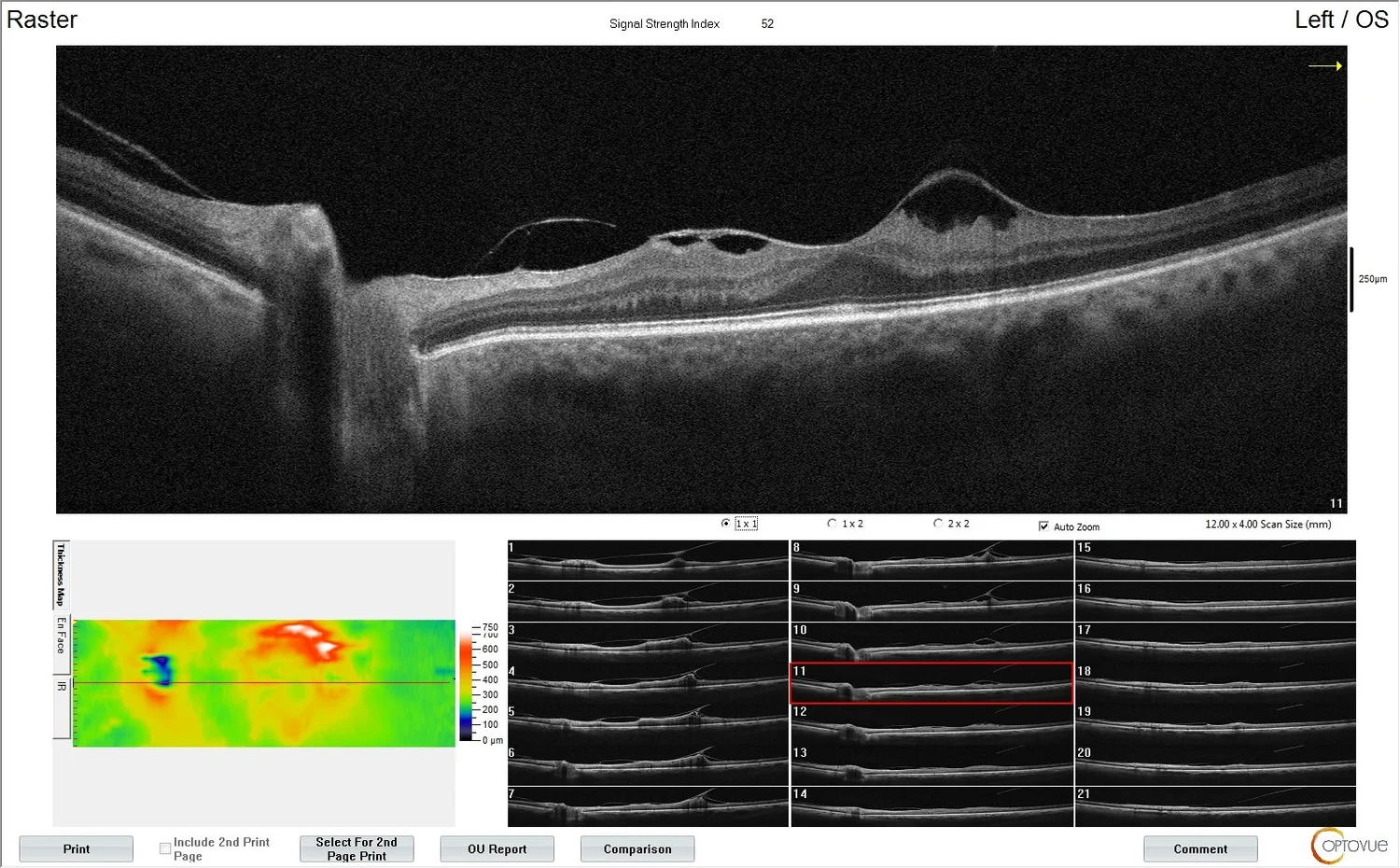 OCT in the Diagnosis of Vitreomacular Disease | Woo University