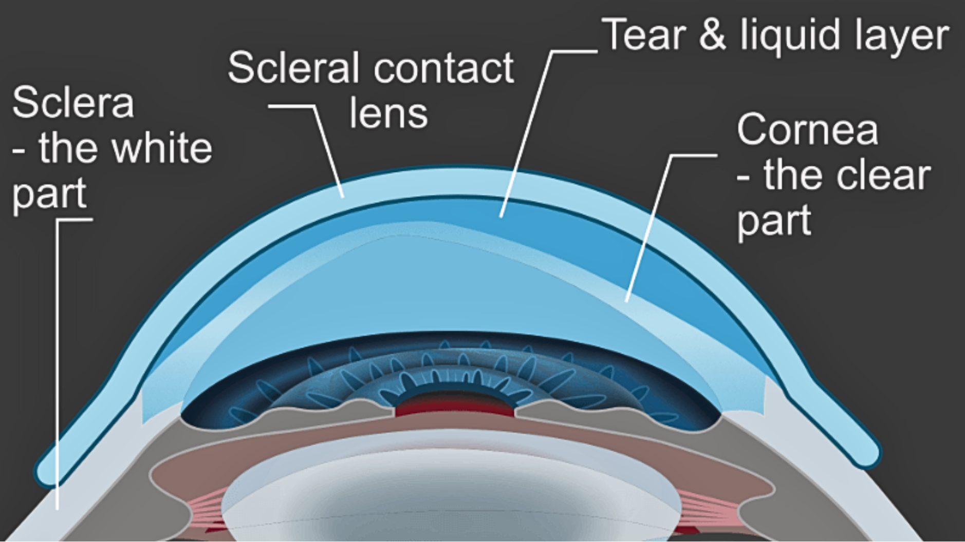 Instrumentation For Scleral Lens Fits | Woo University