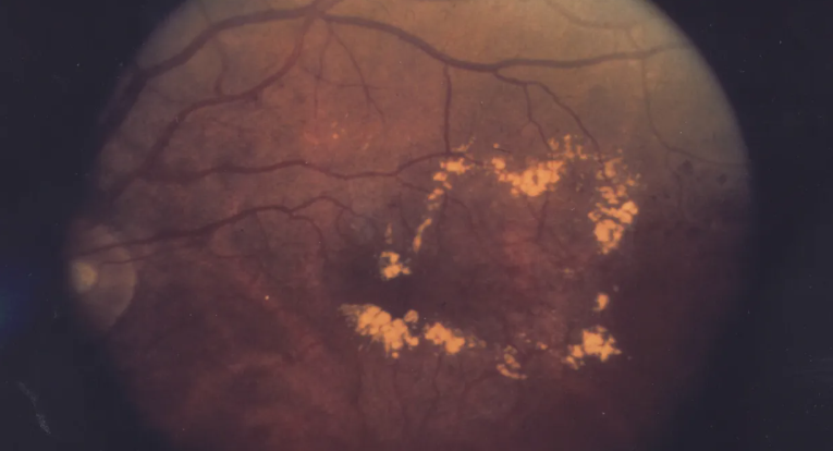 OCT and OCTA Imaging in Diabetes and Diabetic Retinopathy | Woo University