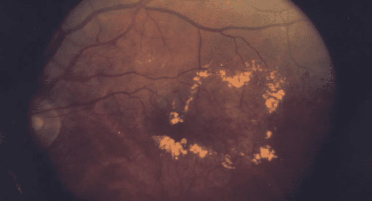 OCT and OCTA Imaging in Diabetes and Diabetic Retinopathy | Woo University