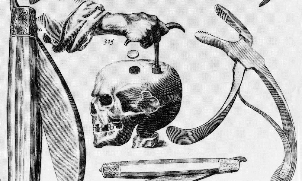 Prehistoric Trepanation: Evidence of Successful Brain Surgery in the ...