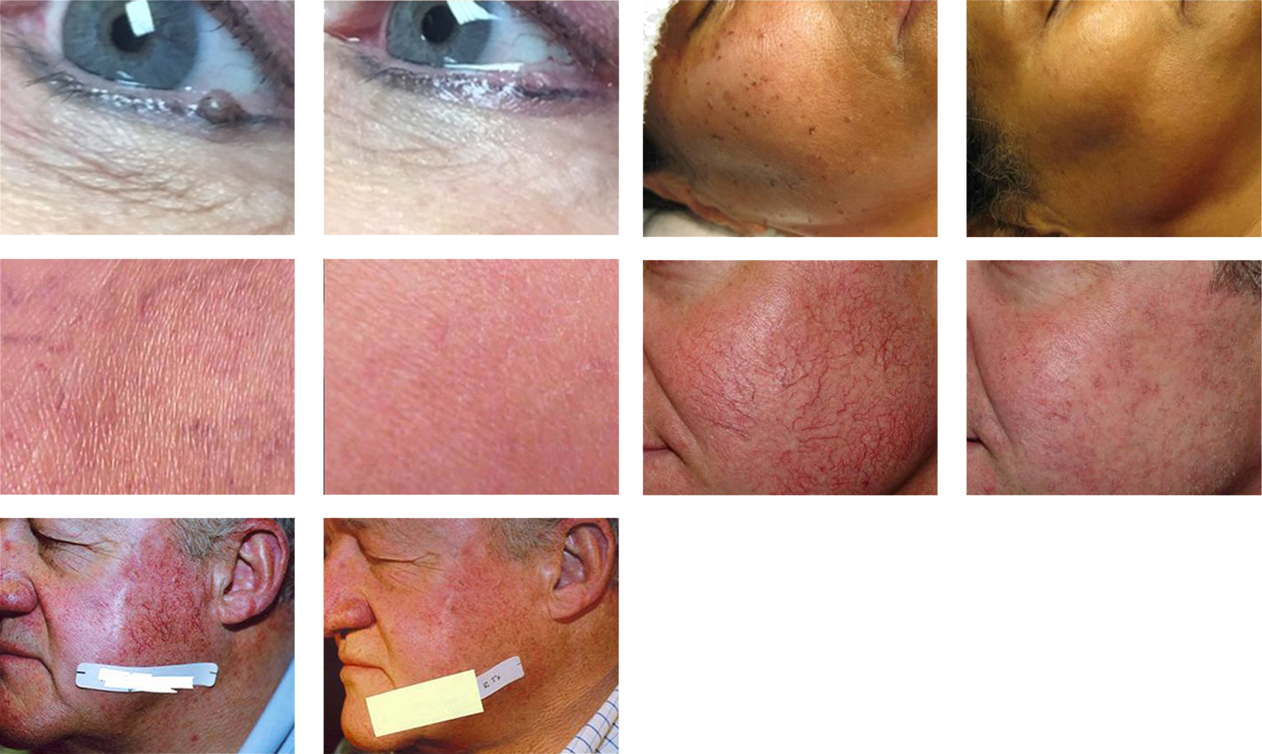 THERMOCLEAR SKIN TREATMENT┃Oakland, CA┃LV Aesthetic — LV Aesthetic