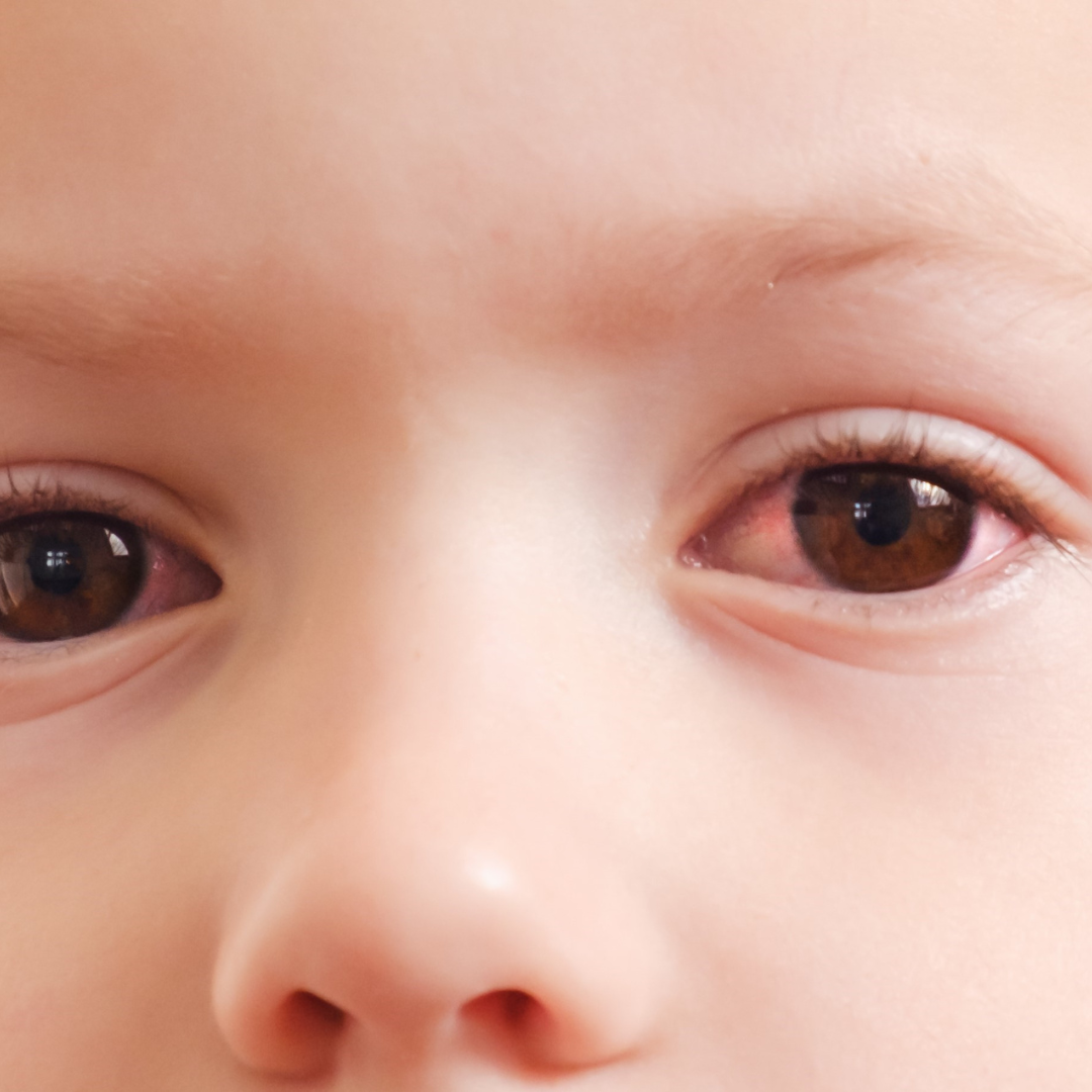 What Is Conjunctivitis THE PEDIATRICIAN MOM