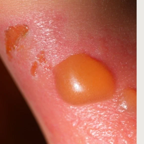 How to treat sunburns in children — THE PEDIATRICIAN MOM