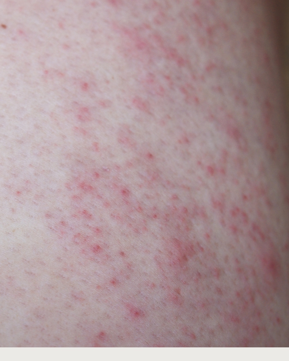 Heat rash in children — THE PEDIATRICIAN MOM