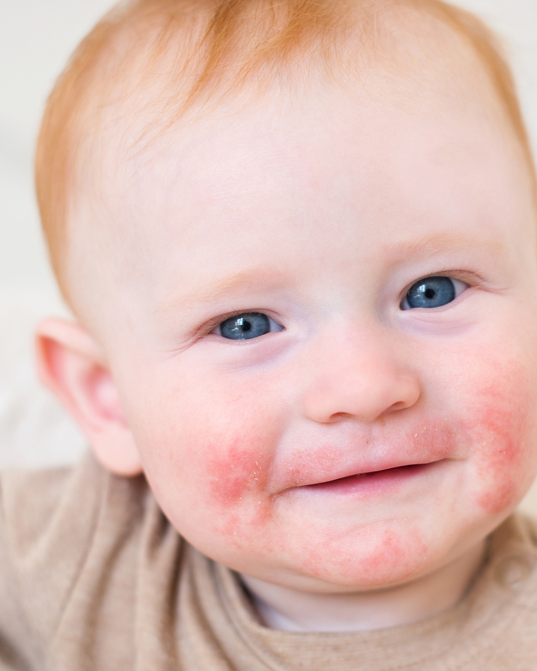 Understanding Eczema In Kids THE PEDIATRICIAN MOM Understanding Eczema In Kids THE PEDIATRICIAN MOM