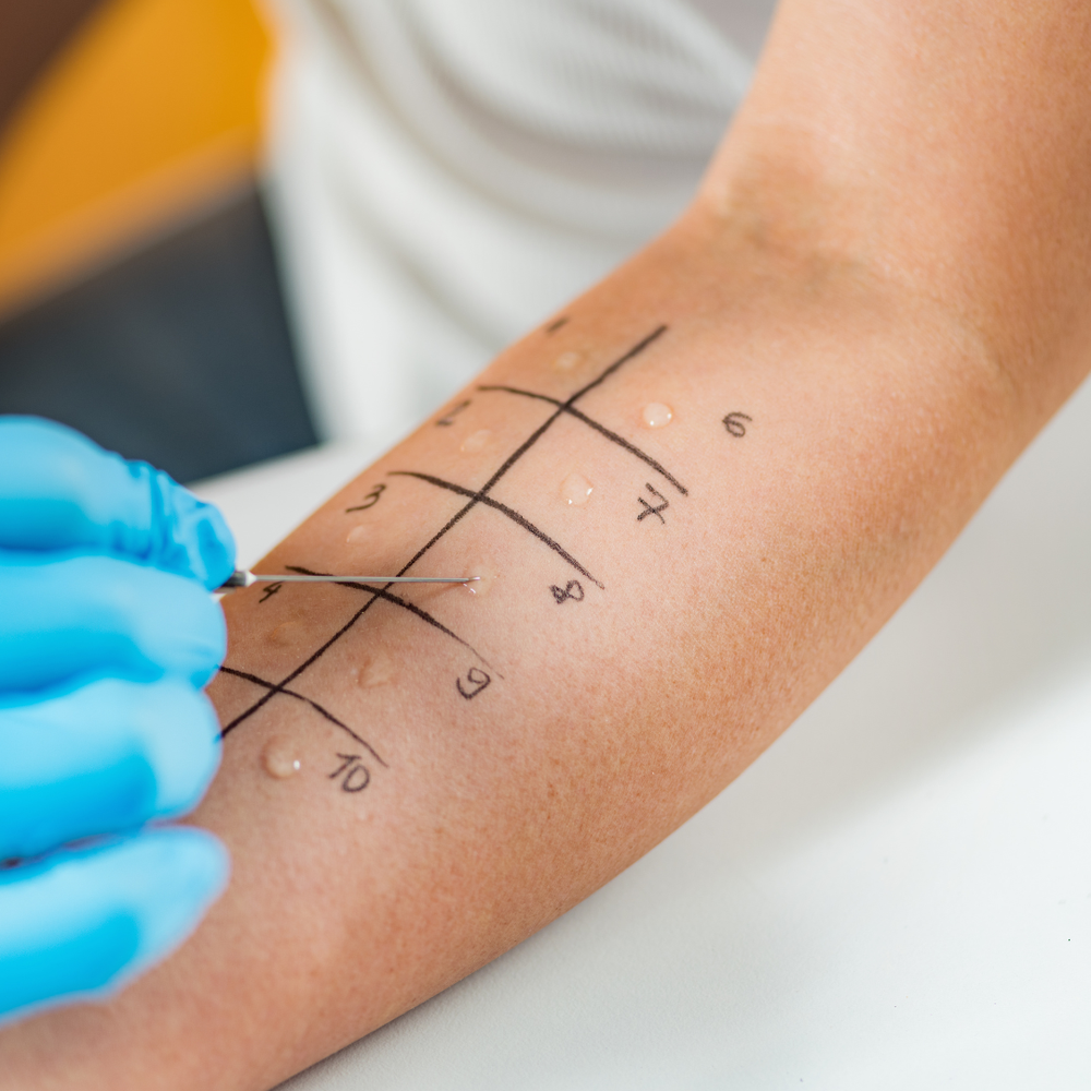 Eczema: triggers and grading — THE PEDIATRICIAN MOM