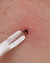 What to do if you find a tick on your child — THE PEDIATRICIAN MOM