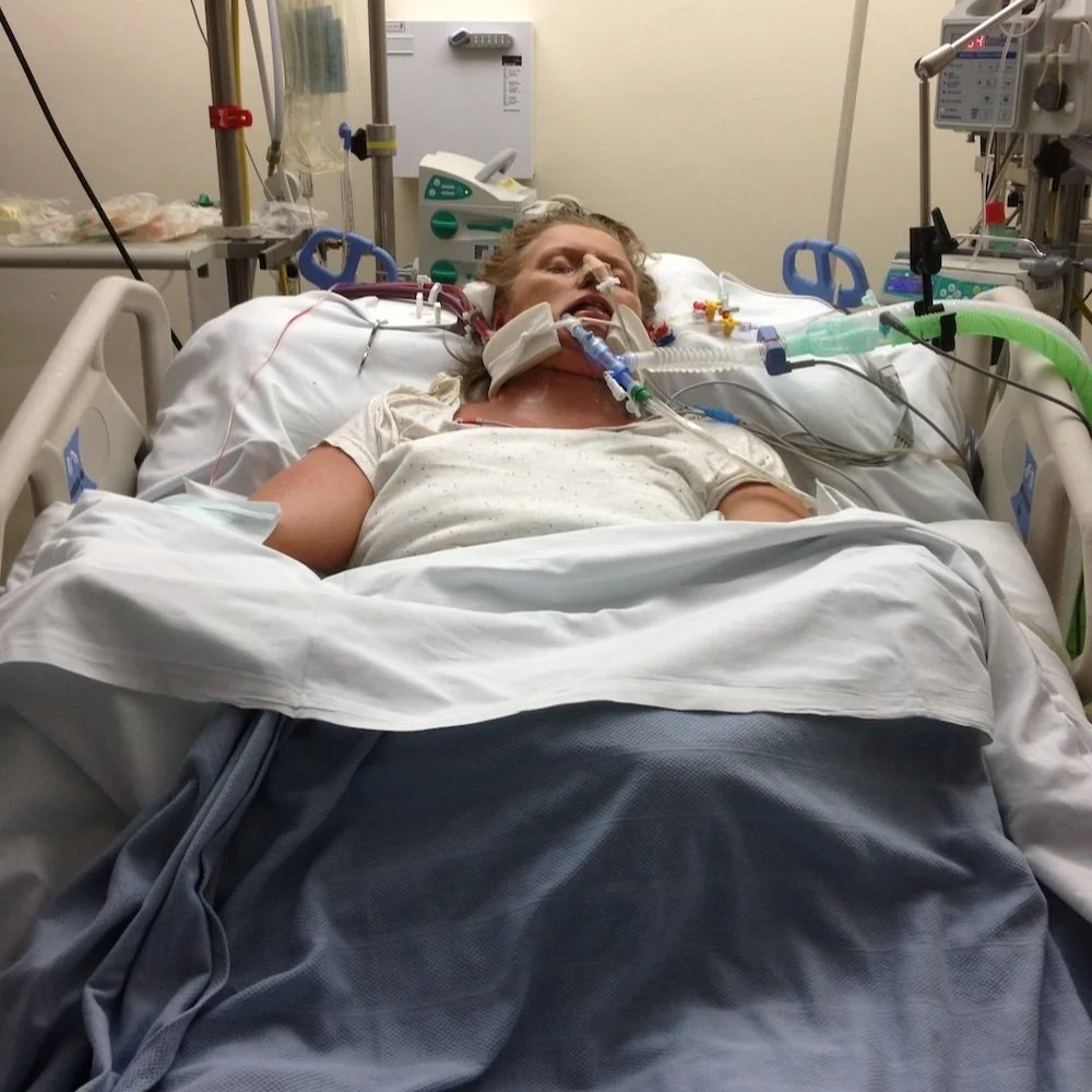 Sepsis and Amputation: A Complete Guide - By Finding Your Feet — Limb ...