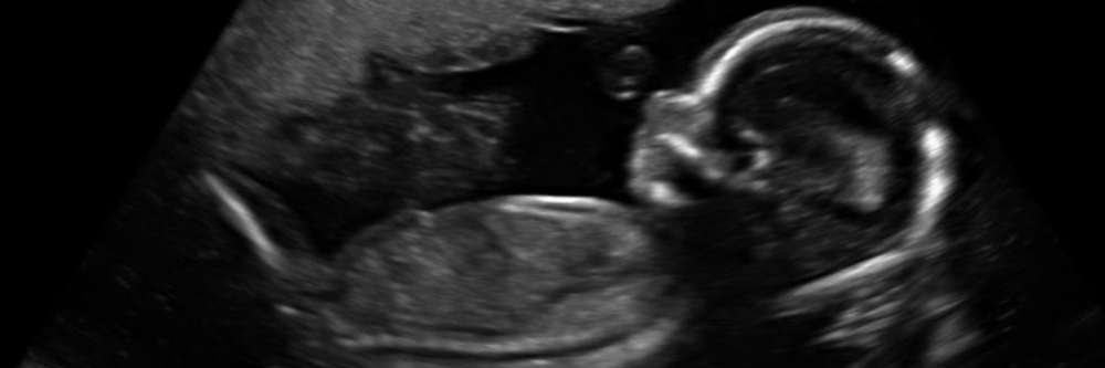 Pregnancy Ultrasound | 3D Ultrasound Springfield, MO — Imaging Miracles
