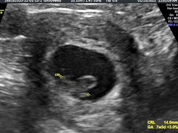 Frist Trimester — Sweetface Scans