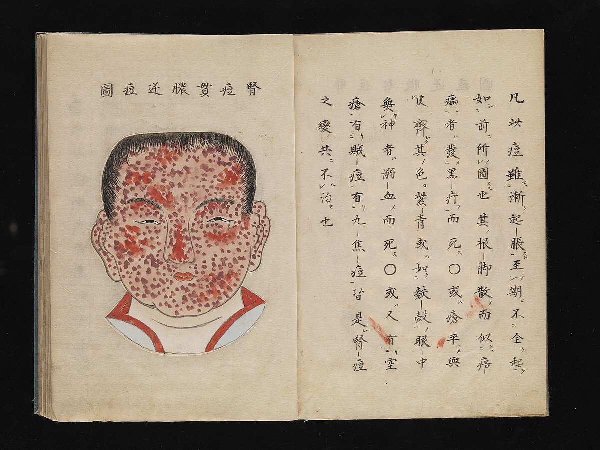 Smallpox: The Disease That Made History — Superbugs - The microbial ...