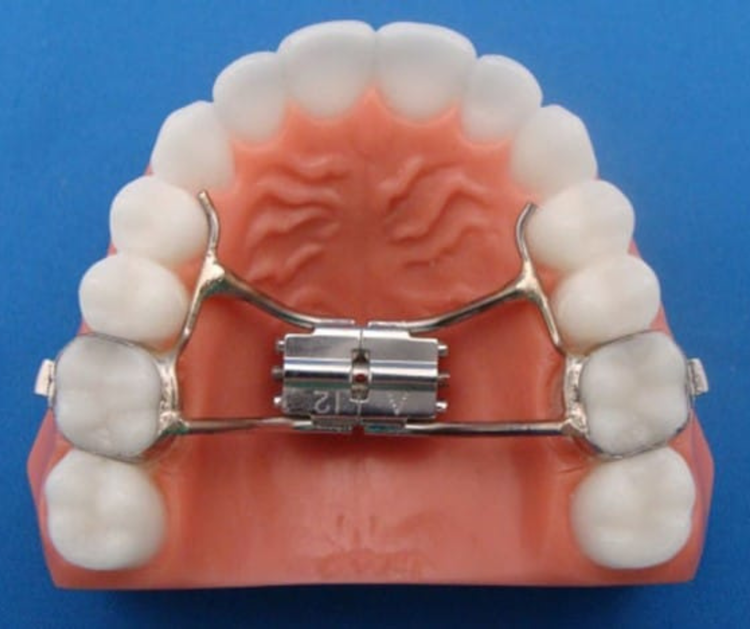 How Palatal Expanders Work: Benefits of Early Orthodontic Treatment — All Star Orthodontics