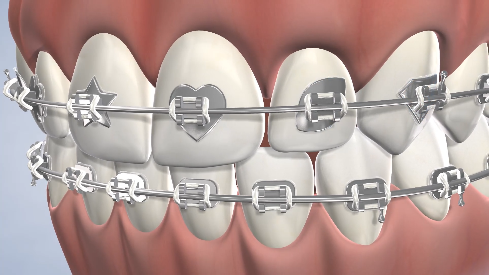 WildSmiles Braces: Express Yourself with Unique Orthodontic Options in ...