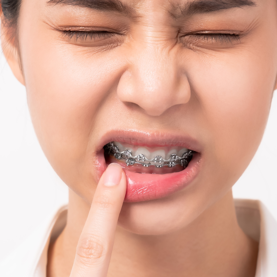 How to Handle Common Orthodontic Emergencies: A Guide for Existing ...