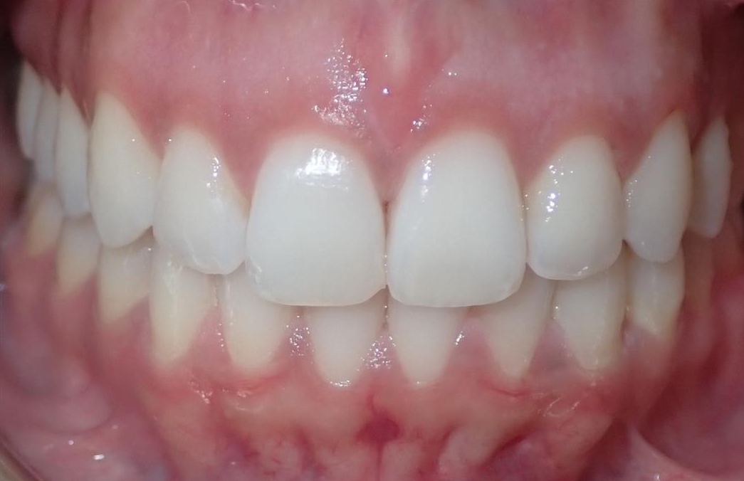 Smile Transformations: Before and After Orthodontic Cases | All Star ...