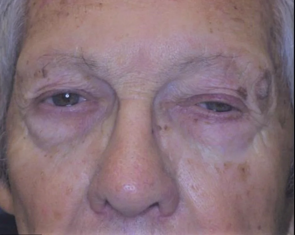 Eye Lid Surgery Pre and Post Operative Photos — Patient Info