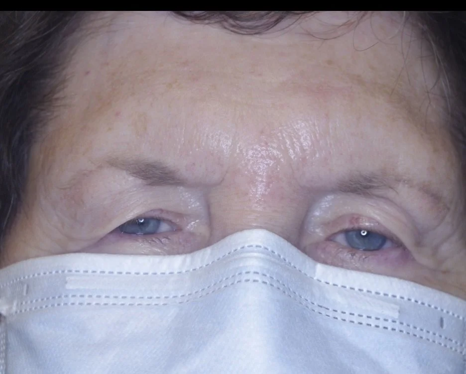 Eye Lid Surgery Pre and Post Operative Photos — Patient Info