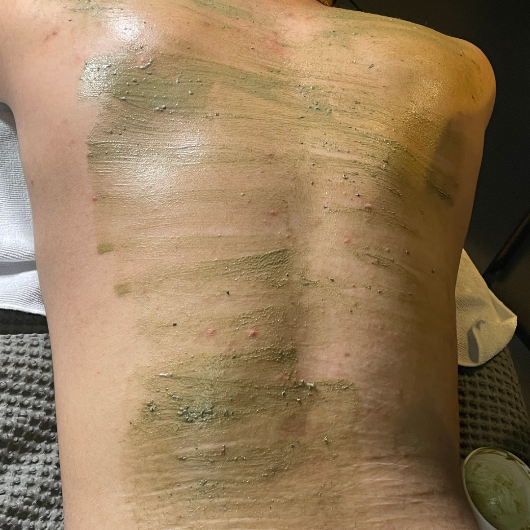 Back Facial Treatment Bryan College Station — Aggieland Aesthetics